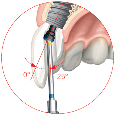 ASC Abutment - RDL - A Full Service Dental Lab