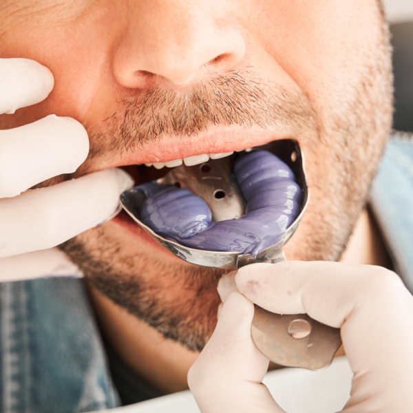 Traditional Impression, Digital Denture with Try-In Workflow (ED2-P) (4 ...